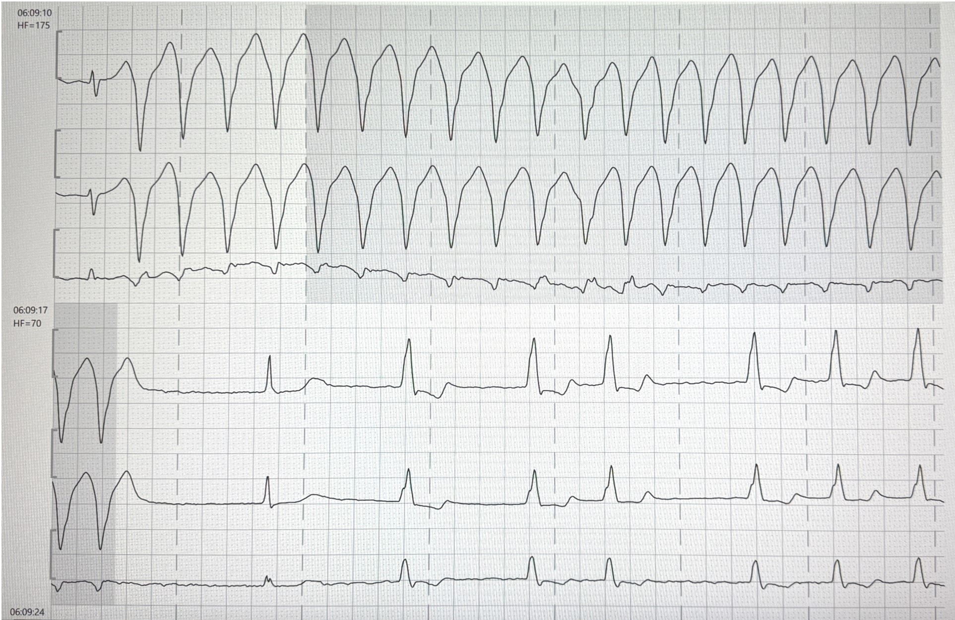 Left Bundle Branch Block Ecg Bifascicular Blocks What You Need To